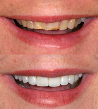 How To Ruin A Smile Makeover - Distinctive Smiles of Dublin