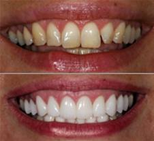 How To Ruin A Smile Makeover - Distinctive Smiles of Dublin